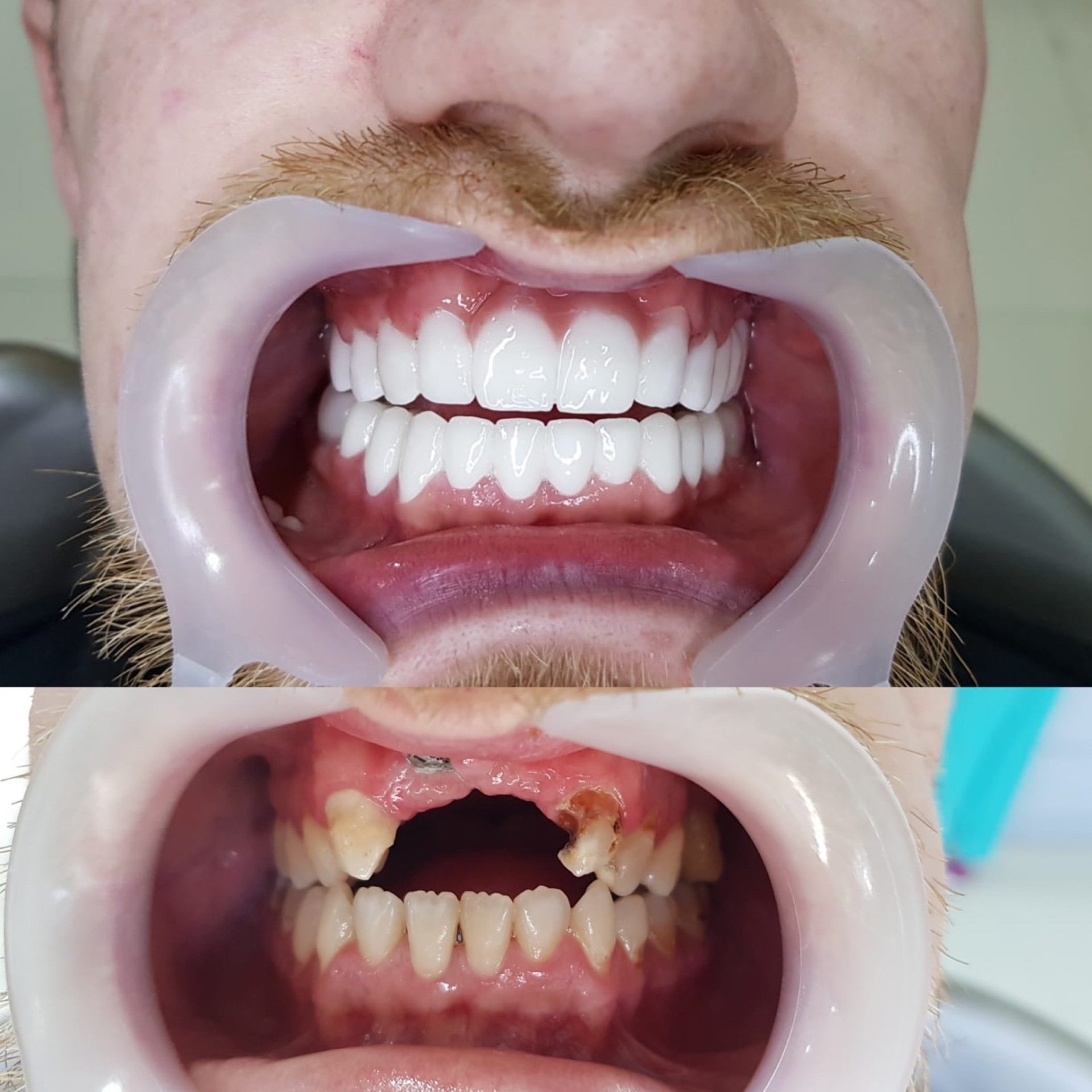 UK Smiles Dental Clinic In Turkey
