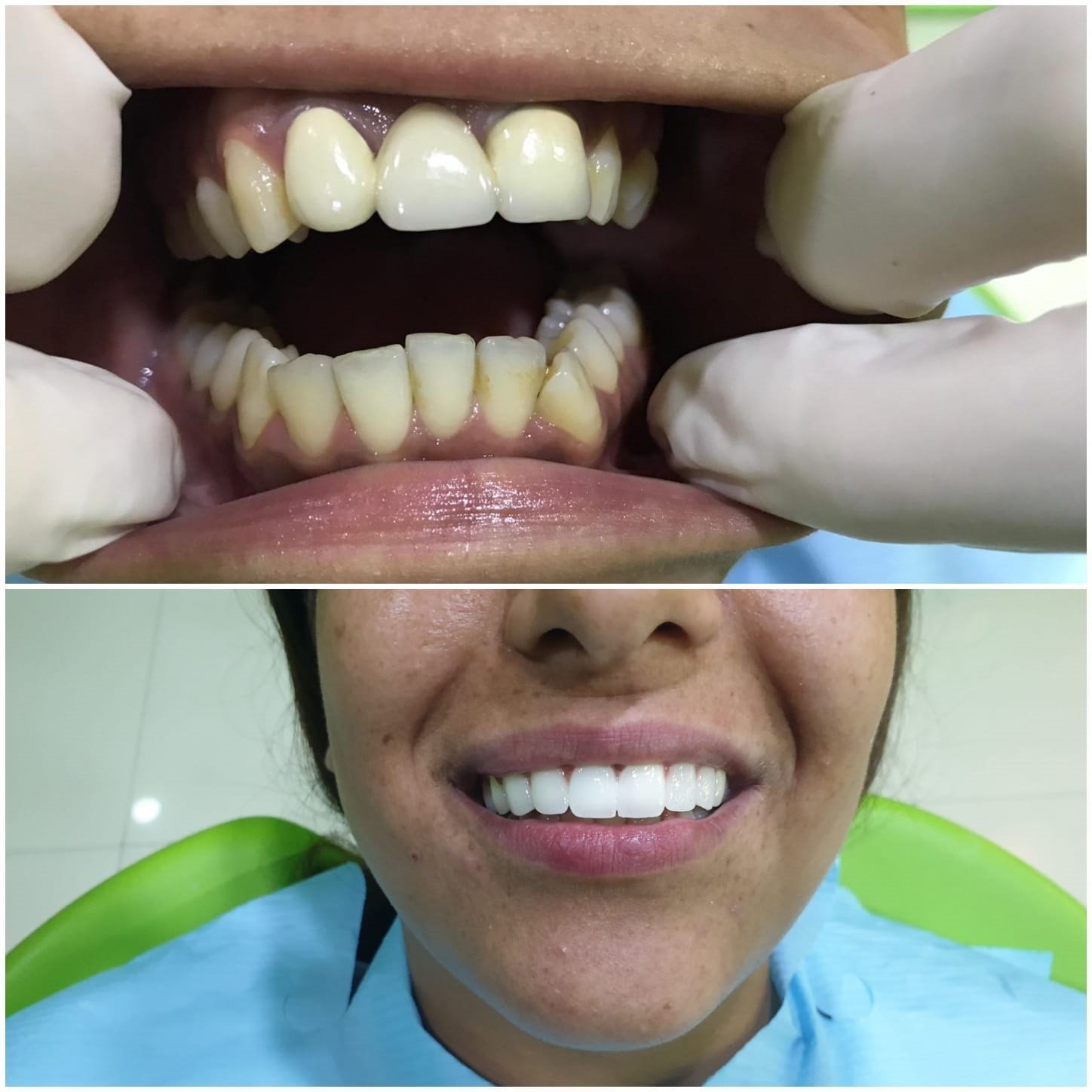 UK Smiles Dental Clinic In Turkey