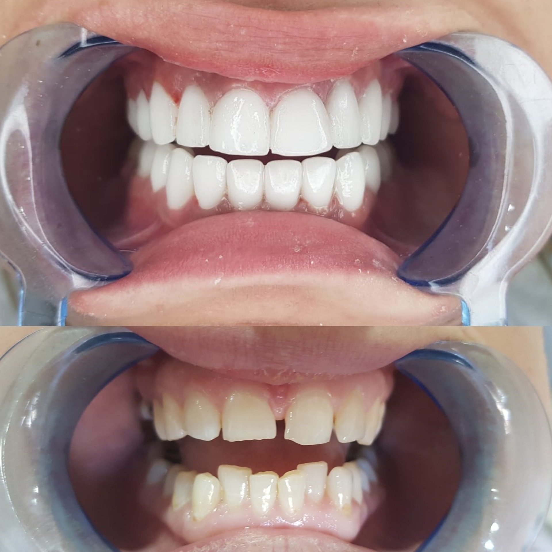 UK Smiles Dental Clinic In Turkey
