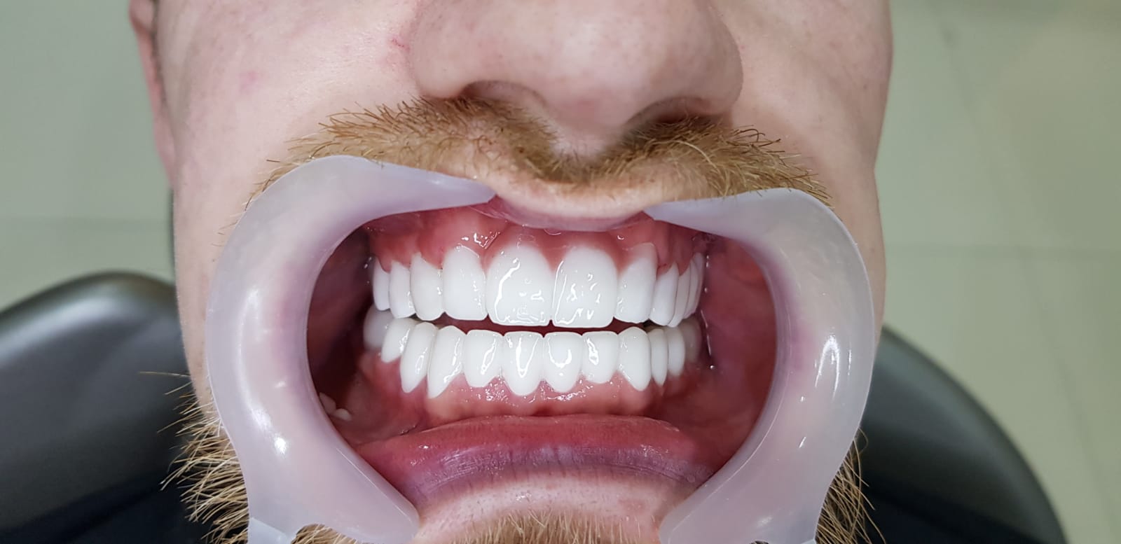 UK Smiles Dental Clinic In Turkey