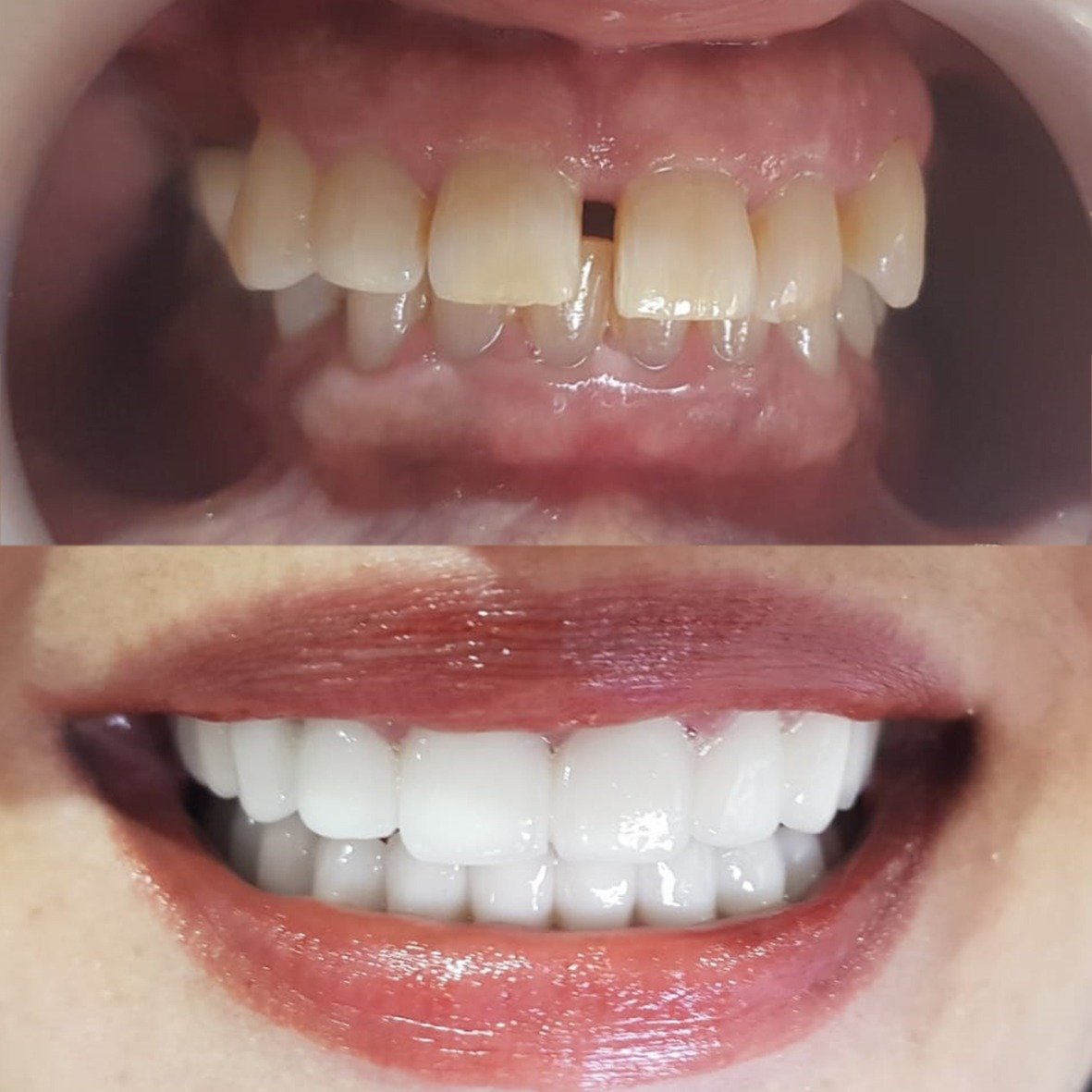 UK Smiles Dental Clinic In Turkey