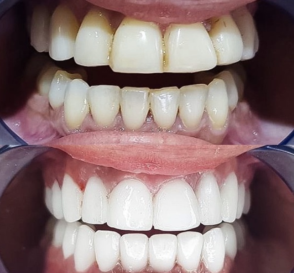 UK Smiles Dental Clinic In Turkey