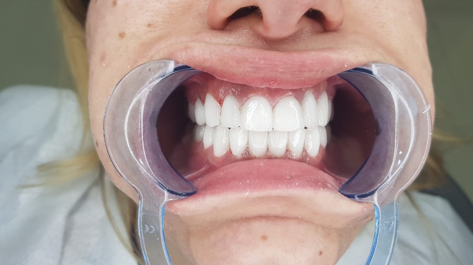 UK Smiles Dental Clinic In Turkey