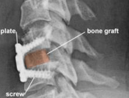 Anterior Cervical Discectomy and Fusion (ACDF)| OrthoSpine Advance ...
