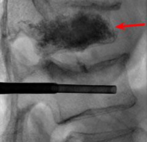 Kyphoplasty | OrthoSpine Advance Health, Inc. | Merced, CA