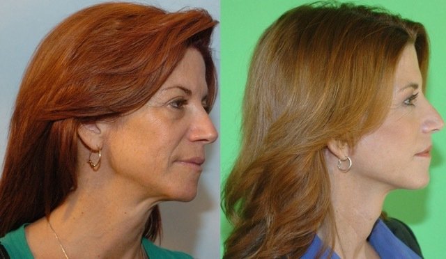 Desert Plastic Surgery Center | EuroLift Before and After | Coachella ...