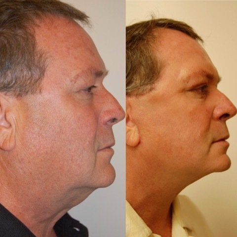 Desert Plastic Surgery Center | EuroLift Before and After | Coachella ...