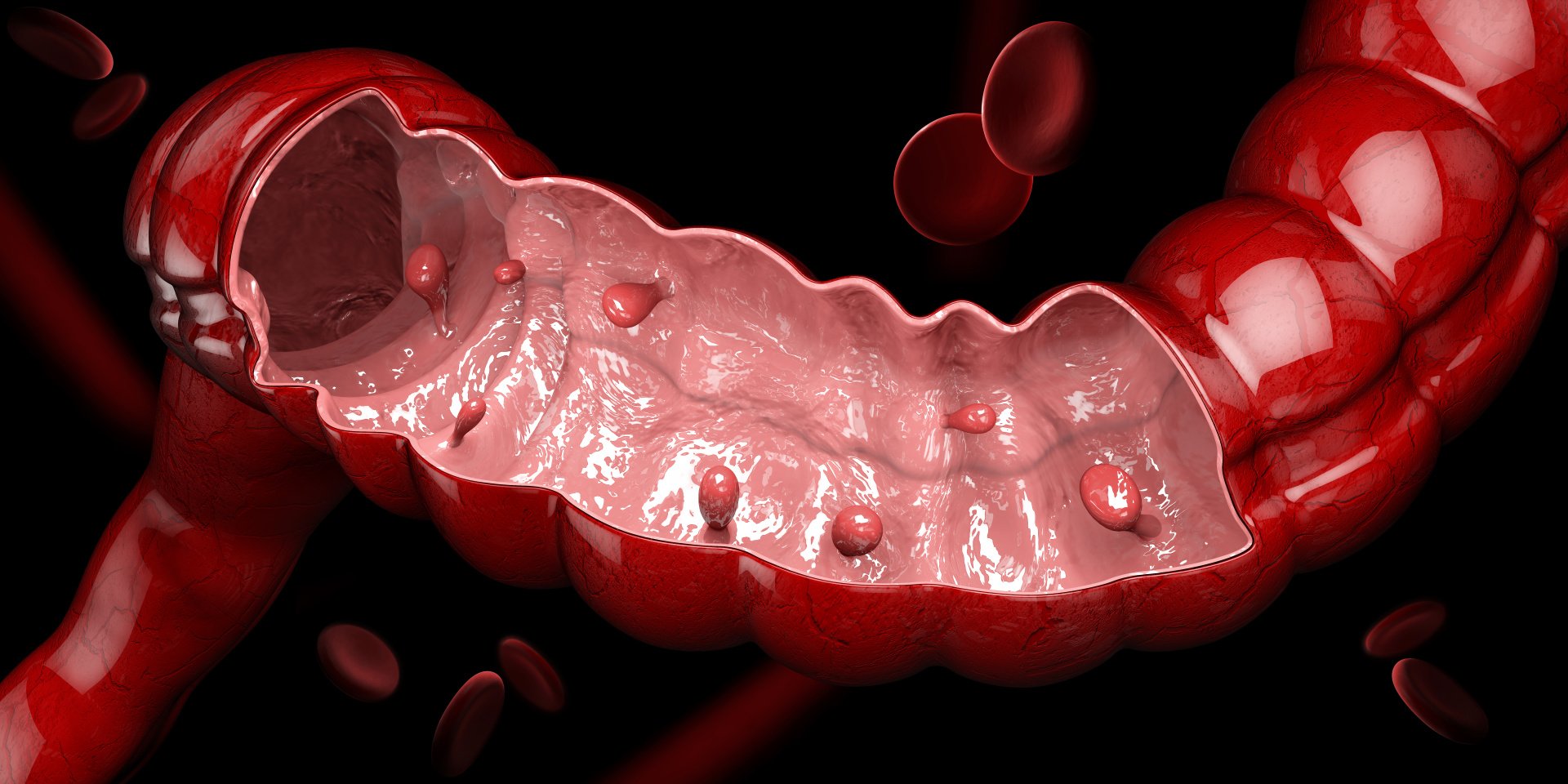 Symptoms Causes And Treatments For Colon Polyps