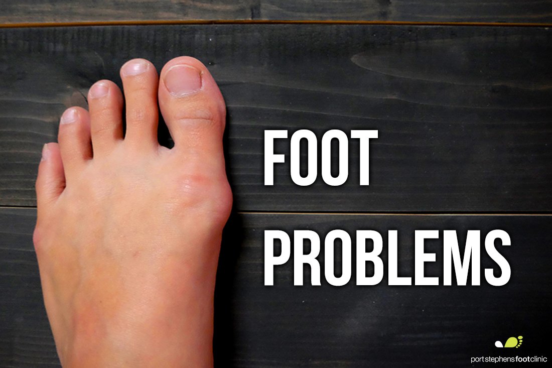 Heel Pain in Children (Calcaneal Apophysitis) | Port Stephens Foot Clinics