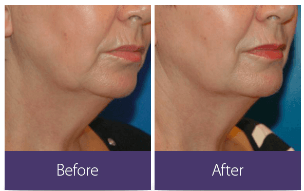 Laser Fat Removal | Walnut Creek, CA | Lavoro Laser