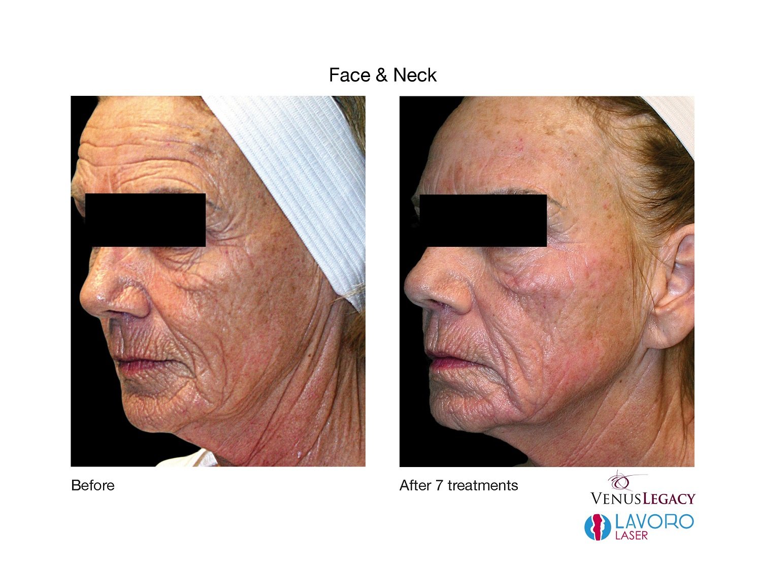 Venus Legacy Before & After Gallery | Skin Tightening Services in ...