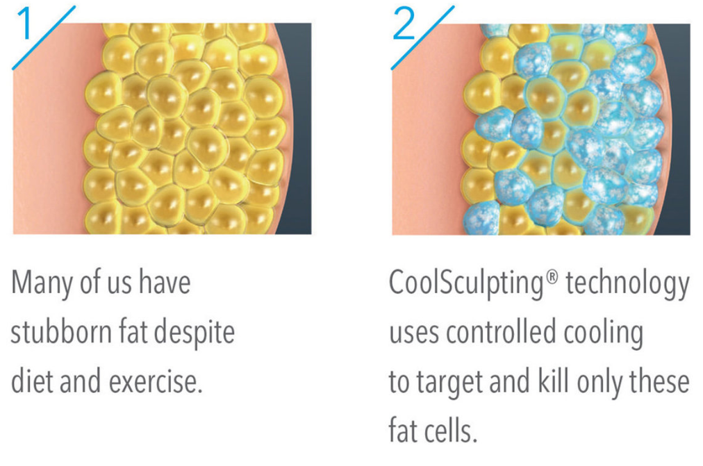 IPL Laser Treatment | Columbus, OH | Encore Dermatology