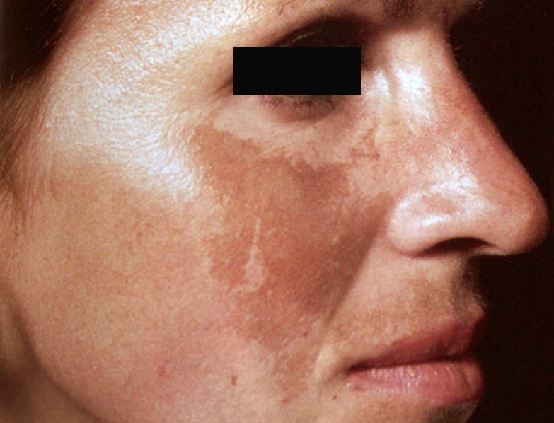 Melasma Treatment | Women's Health & Cosmetic Services | Baltimore, MD