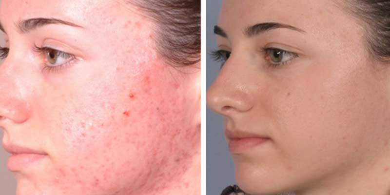 Cryotherapy Now In Palm Harbor & Pinellas | Cryo Facials & Wholebody