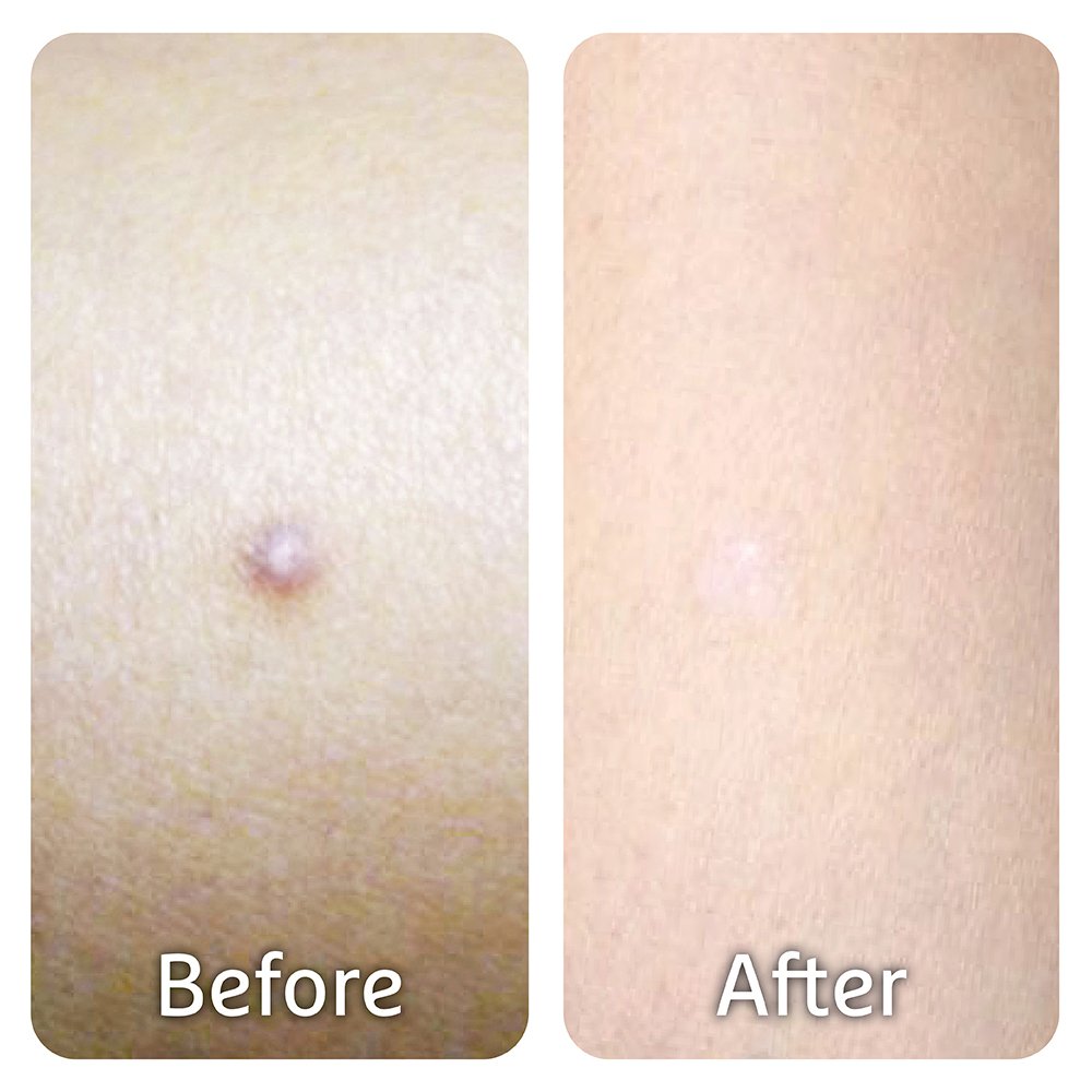 Orlando Skin Lesion Removal, Winter Park Skin Lesion Removal