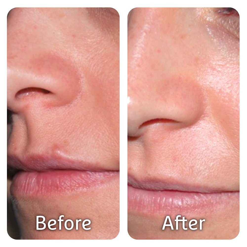 Orlando Skin Lesion Removal, Winter Park Skin Lesion Removal