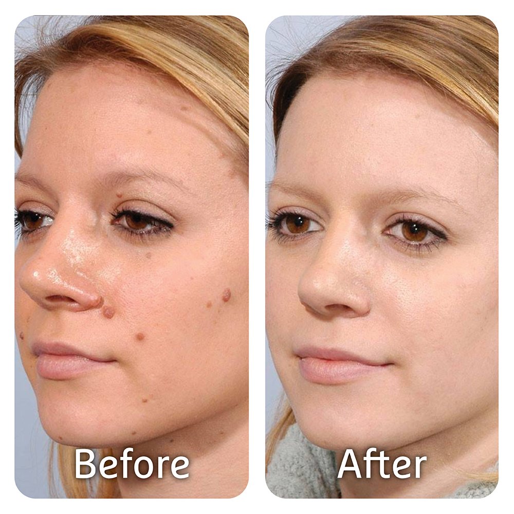 Orlando Skin Lesion Removal, Winter Park Skin Lesion Removal