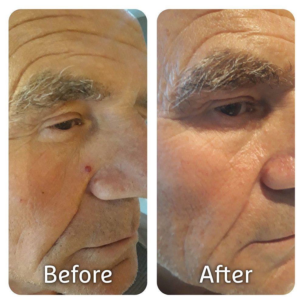 Orlando Skin Lesion Removal, Winter Park Skin Lesion Removal