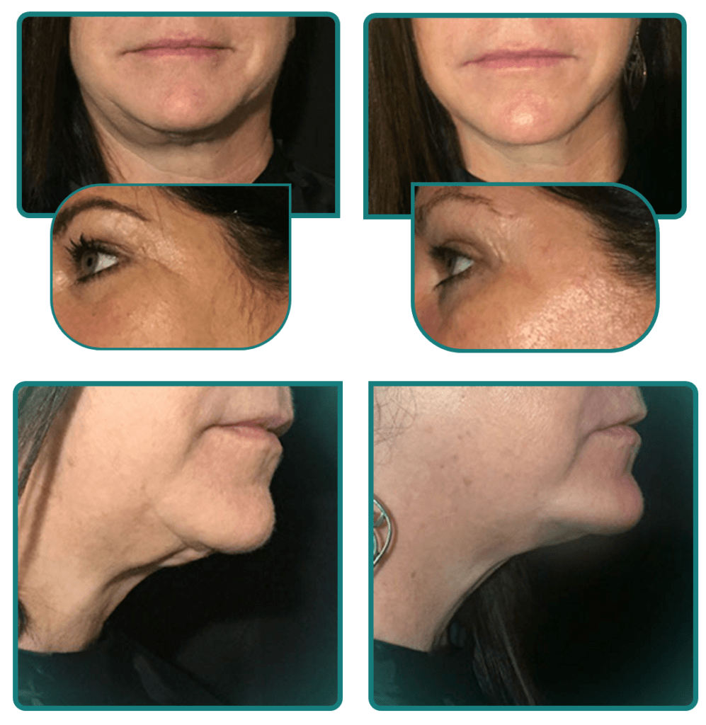 Cosmetic Acupuncture Results