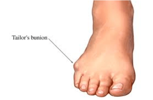 Tailor’s bunion