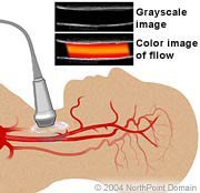 DUPLEX ULTRASONOGRAPHY
