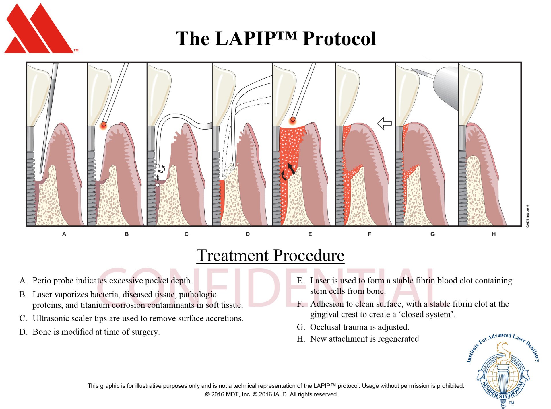 LAPIP (Laser Assisted Peri-Implantitis Protocol) | Sydney