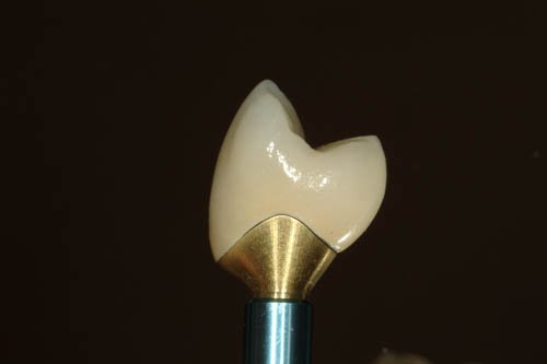 Implant Supported Premolar Crown