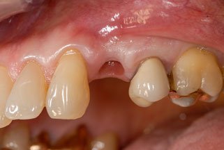 Implant Supported Premolar Crown