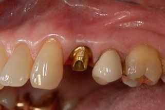 Implant Supported Premolar Crown
