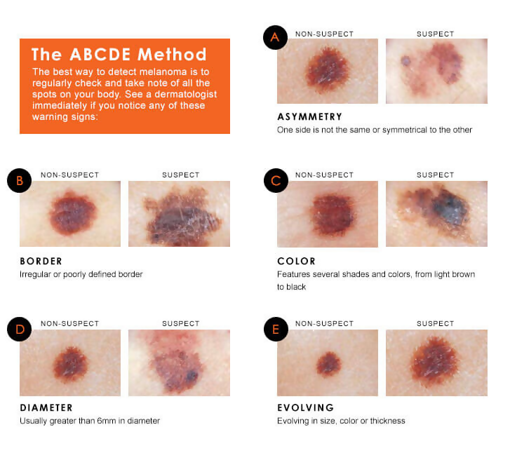 Have you had a Skin Check Recently?