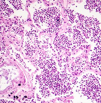 Pathology Services | Chattanooga, TN | Diagnostic Pathology Services PC