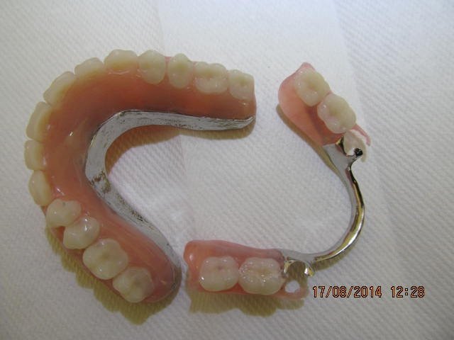 Partial Dentures in Reservoir and Keysborough | Denture Clinics