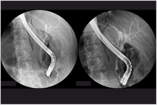 Procedures for Stomach, Liver, Pancreas and Esophageal Disorders