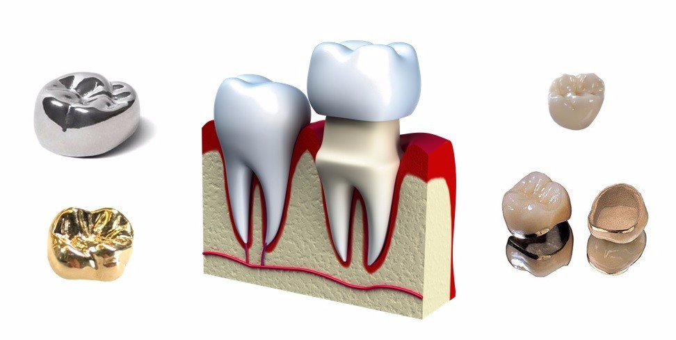 Dental Crowns