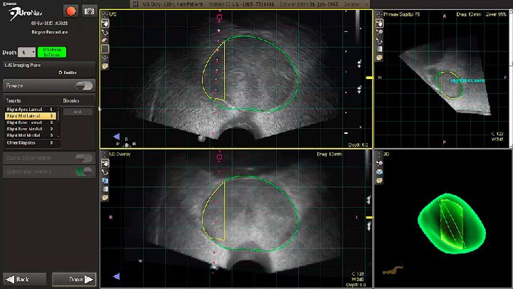 Prostate Biopsy- Smart Biopsy | San Antonio | The Urology Place