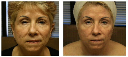 Skin Rejuvenation Services | Tarrant County, TX | AlecXander Medical Spa