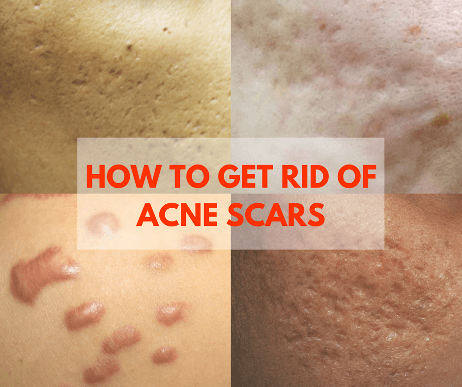 Different Types Of Acne Scars