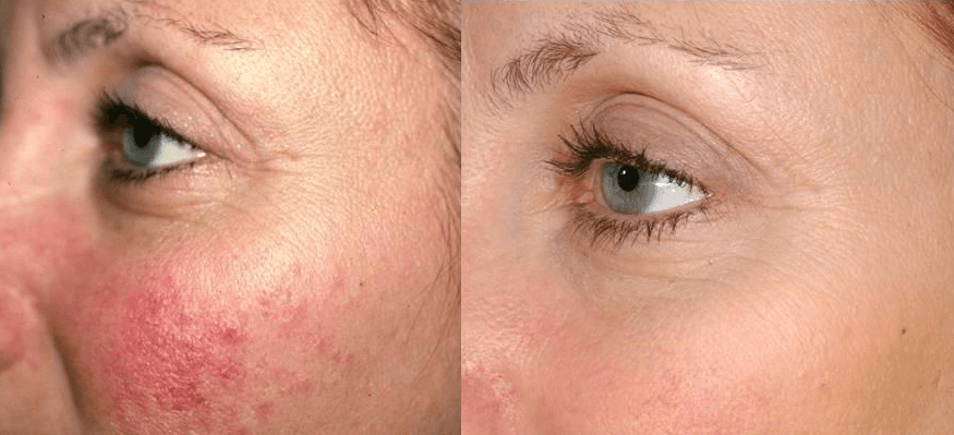 Laser Genesis Treatment | MaxAesthetics | Philly