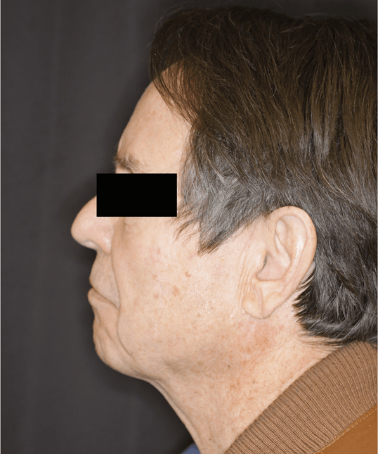 Before and After Renuvion Face & Neck and Tight Photos