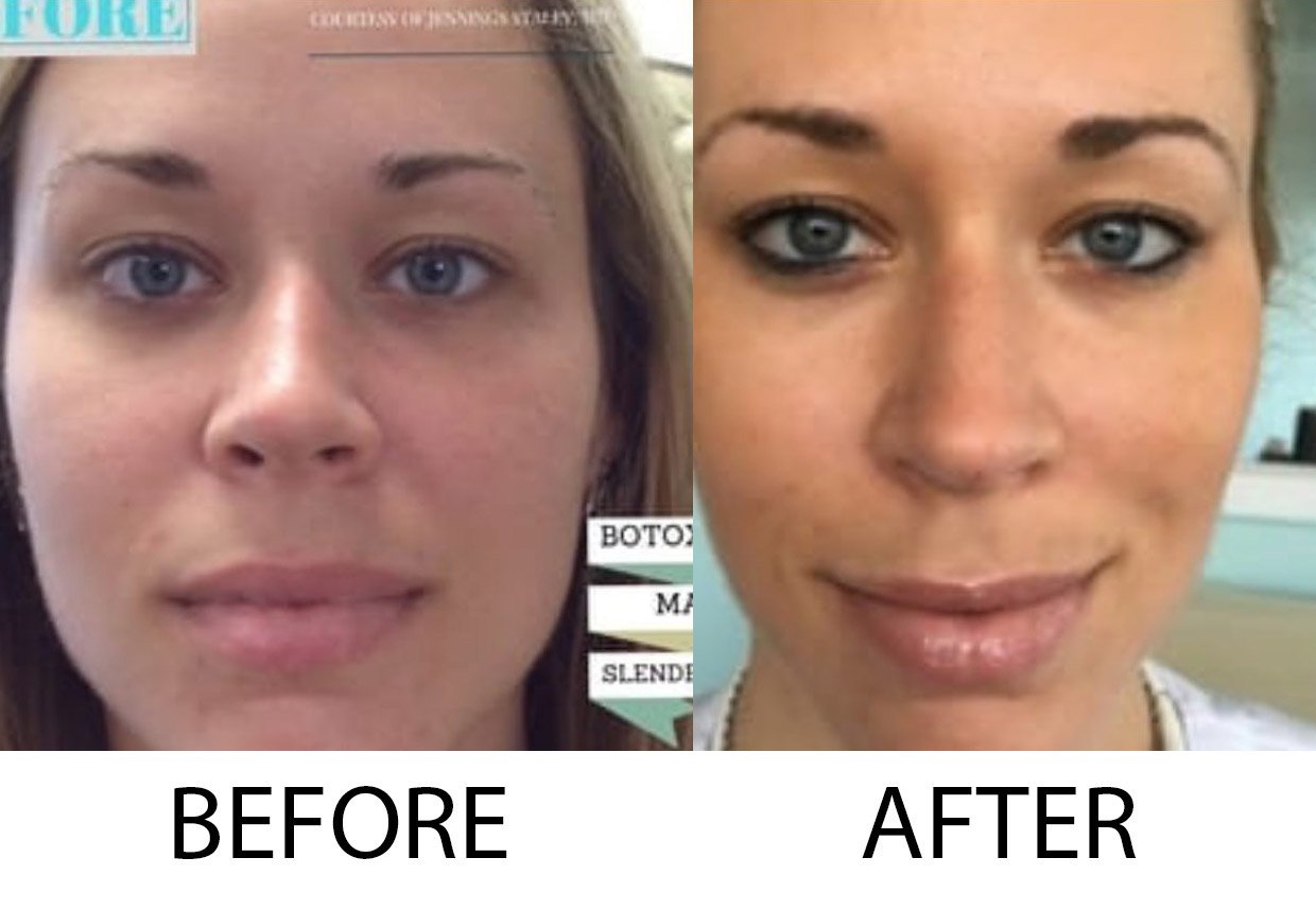 San Diego Masseter Injections - Botox Cosmetic Treatments CA