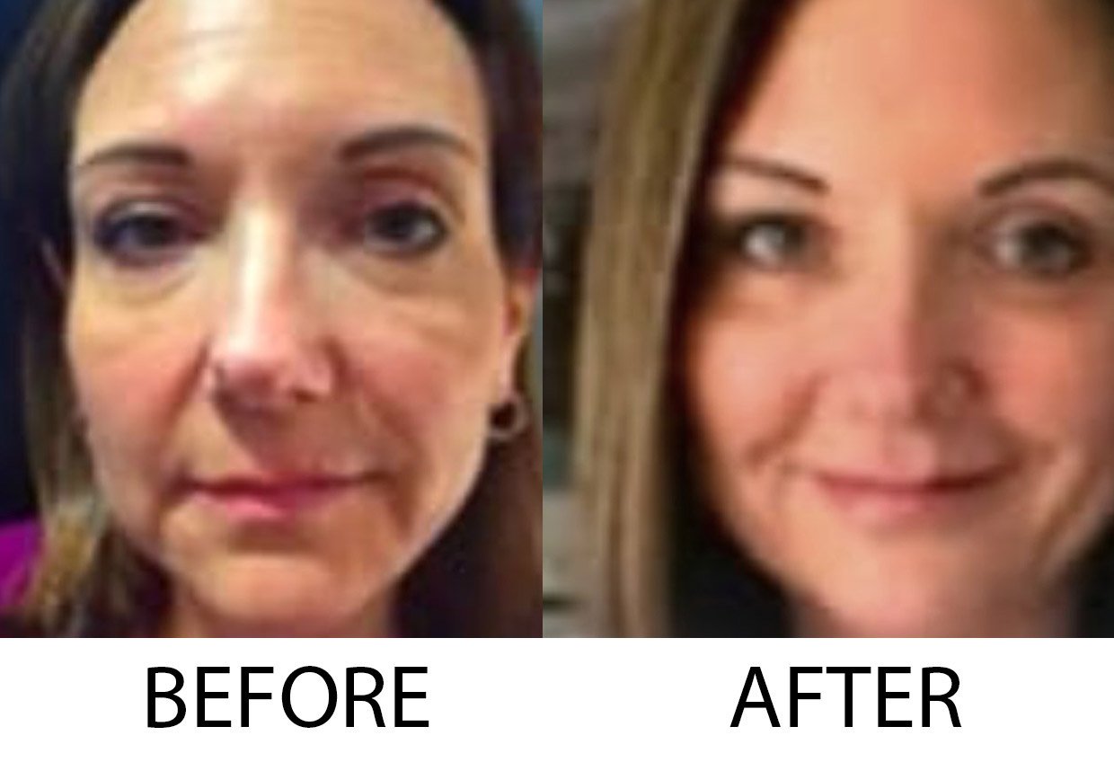 Vampire Facial San Diego - Microneedling Skin Treatment CA