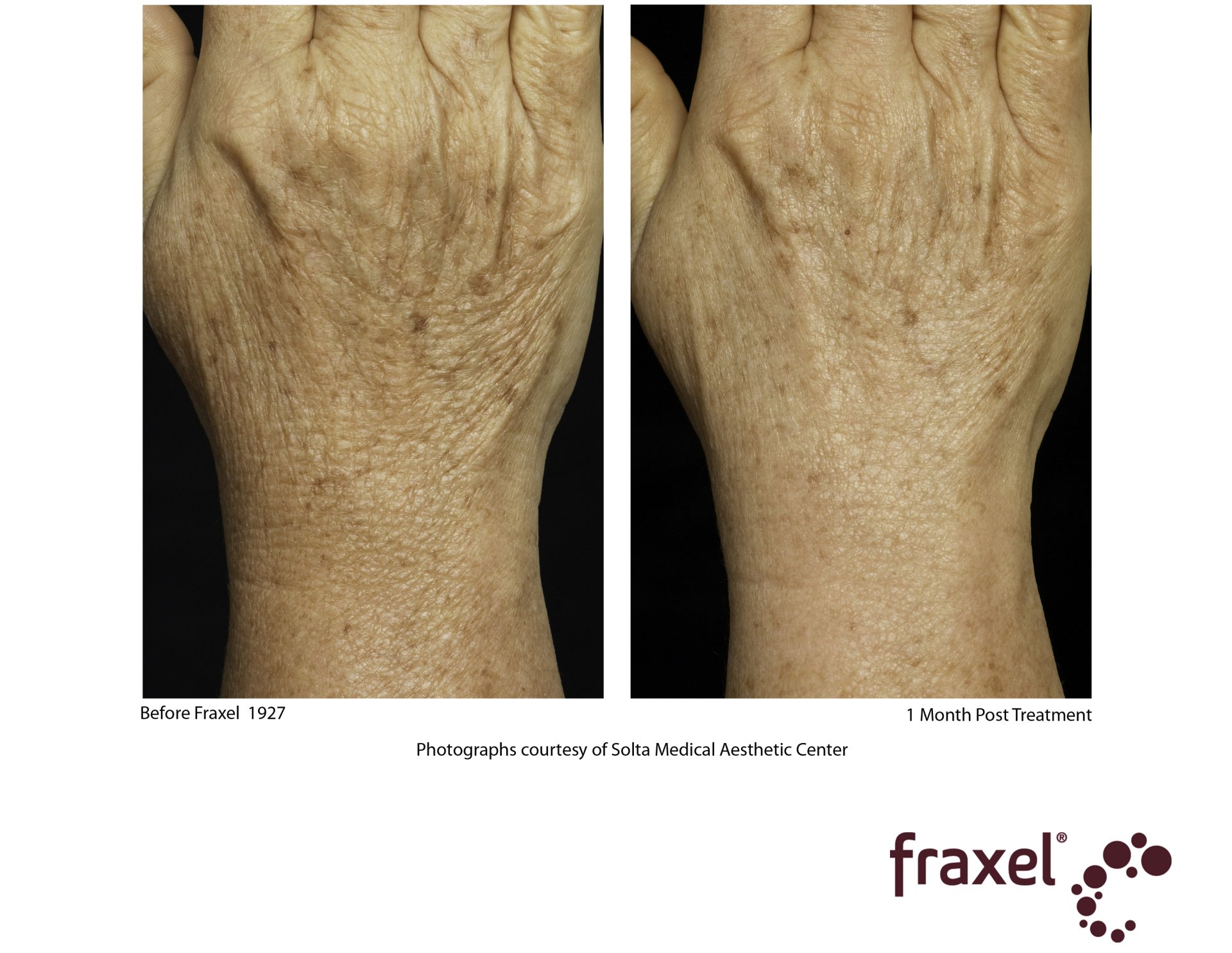 FRAXEL LASER | FOLSOM DERMATOLOGY | FOLSOM, CA