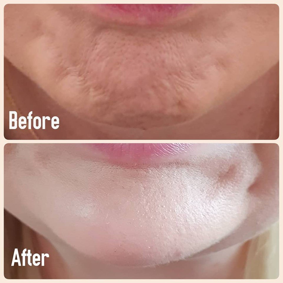 Facial line softening | Lincoln Aesthetic