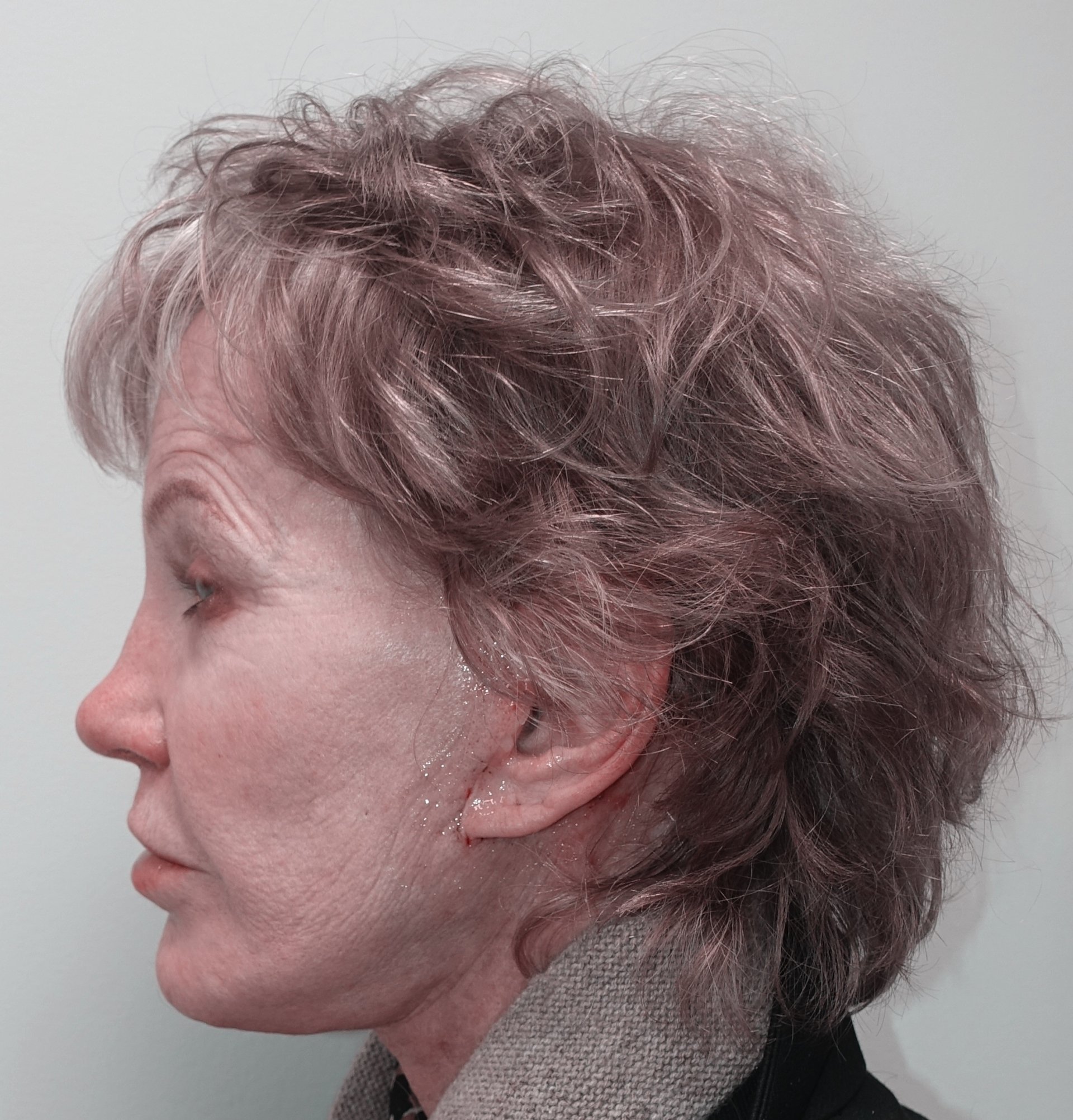 Facelift and Neck lift Gallery - Chandler Plastic Surgery