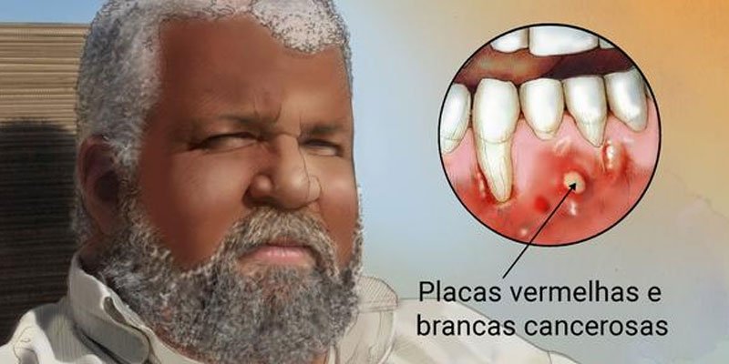 Câncer de Boca | Dr. Genival Barbosa