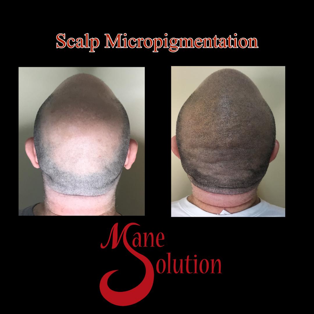 Hair Replacement & Hair Loss Treatment: Latham, NY | Mane Solution