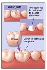 Crowns - Bishop Family Dentistry - Greenwood AR
