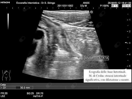 Ecografia anse intestinali | Catania | Dott. Siringo Sebastiano