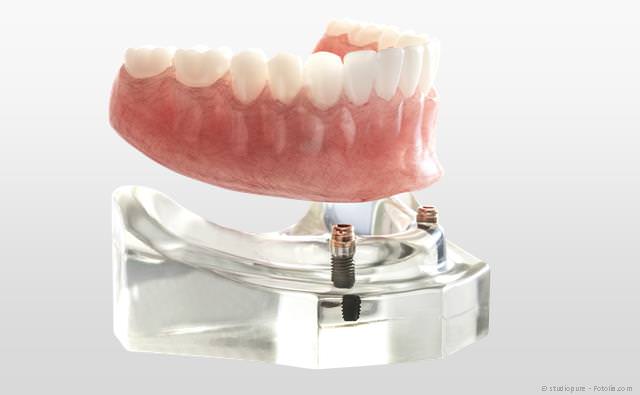 Totalprothesen (Vollprothesen) - Zahnarzt VS-Villingen, Dr. Udo Rohr