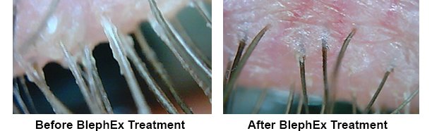 DRY EYE SYNDROME | TUCKER EYE CARE | FAYETTEVILLE, NY